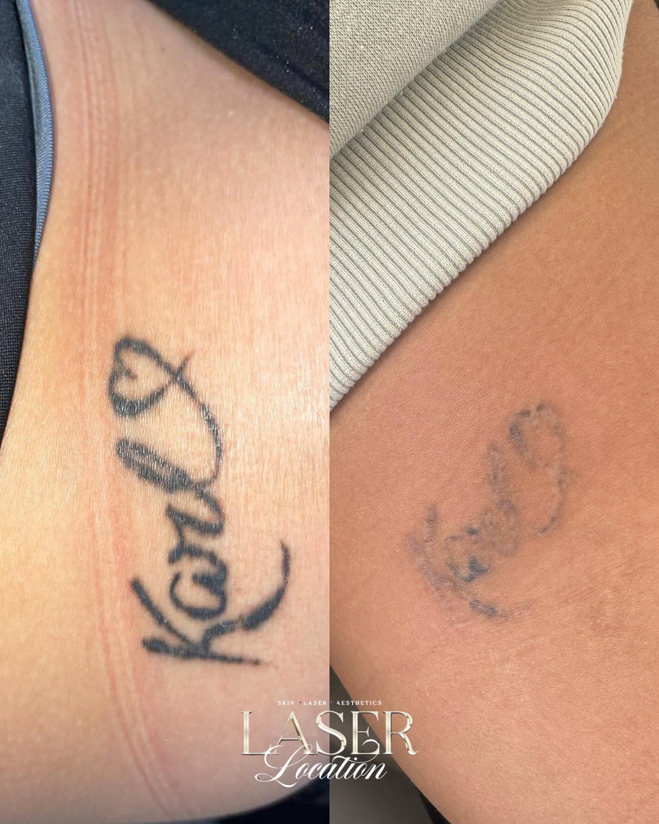 Laser Tattoo Removal Bury | Body & Eyebrow Tattoo Removal | Free ...